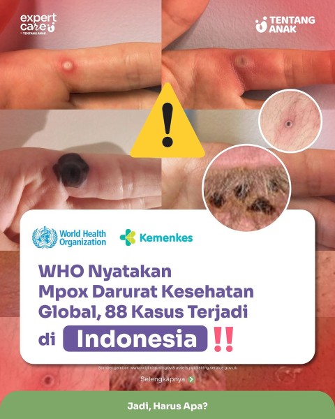 Waspada Penularan Virus Monkeypox. Ini Gejala & Cara Penularannya ...