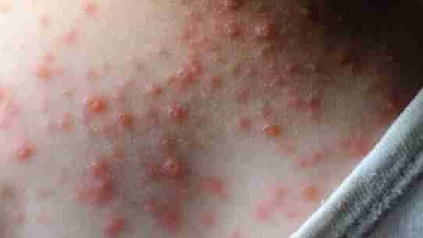 Mengenal Ciri Cacar Air pada Anak dan Cara Mengobatinya agar Tidak Berbekas - Tentang Anak